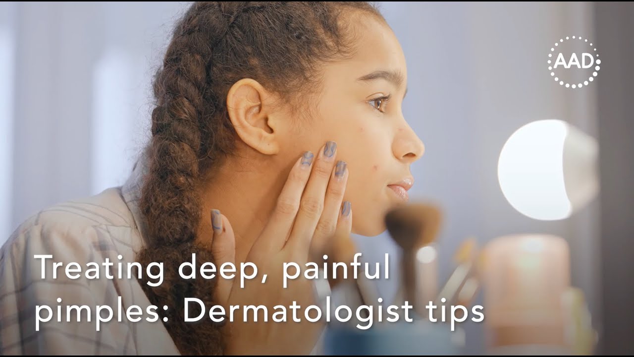 Treating deep, painful pimples: Dermatologist tips | PHDermatology